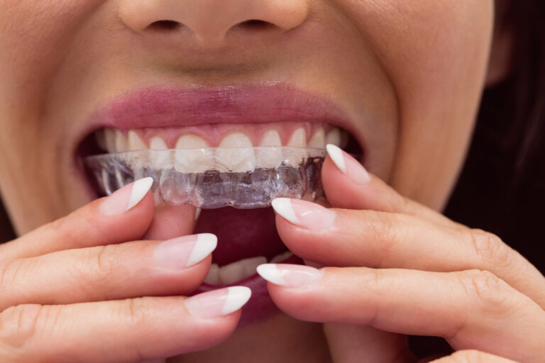 Night Guard Vs Retainer: Which Is Right For Your Smile?